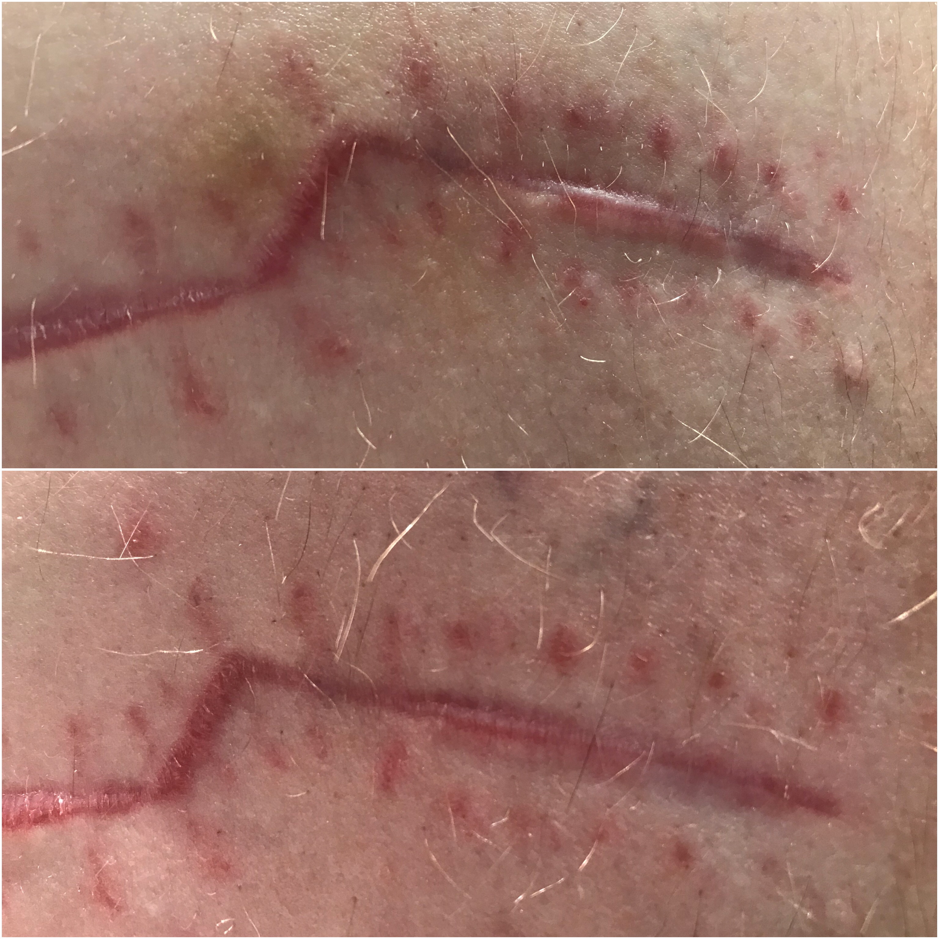 Lymphatic Drainage and Scar Tissue - The Movement Clinic | The Movement ...