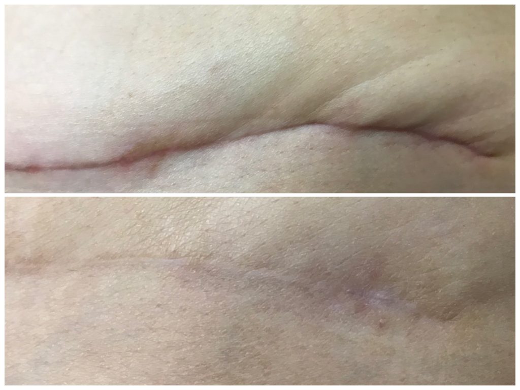 Lymphatic Drainage and Scar Tissue - The Movement Clinic | The Movement ...